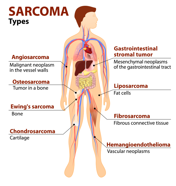 Sarcoma - RTAnswers.org - Answers to your radiation therapy questions. Sarcoma - RTAnswers.org - Answers to your radiation therapy questions.